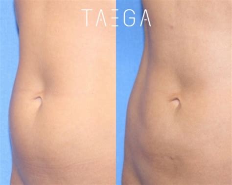 Bodytite Before And After What Real Results Look Like Taega
