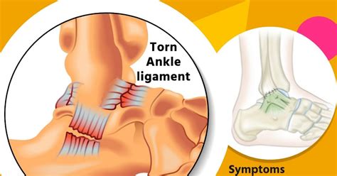 Torn Ankle Ligament