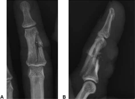 The Syringe External Fixator Short And Medium Term Functional