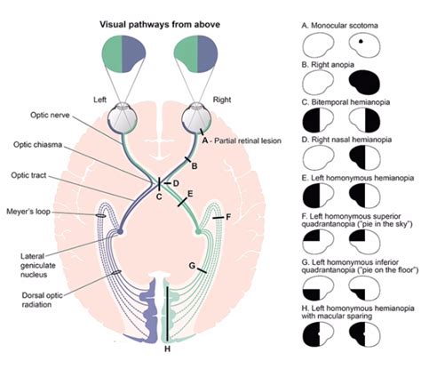 Usmle Notes Visual Defects