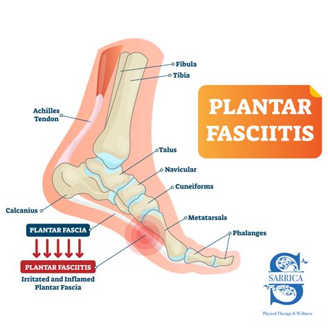 Plantar Fasciitis Symptoms Treatments How Physical Therapists Can