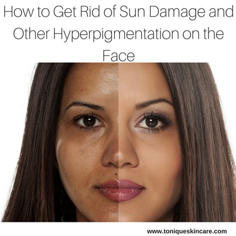 How To Get Rid Of Sun Damage And Other Hyperpigmentation On The Face