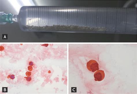 Figure 1 From Hepatic Cystic Echinococcosis Due To Echinococcus Granulosus Grossly Observed By