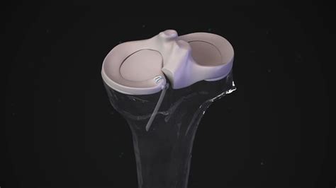 Meniscus Tears Meniscal Root Repair Animation Orthopedia Patient