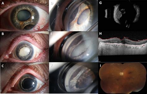 Cataract Progression And Outcome Of A Patient Treated With I 125