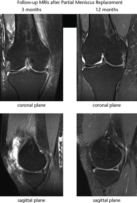 Partial Meniscal Replacement With Collagen Implant Magnetic Resonance