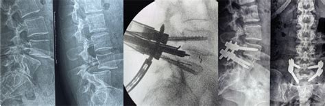 High Grade Listhesis Pre Operative Intraoperative And Post Operative