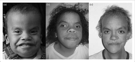 Costello Syndrome About Costello Syndrome