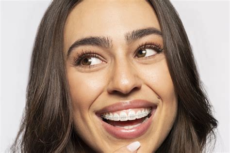 Lightforce Braces Customised Braces Gullotta Orthodontics