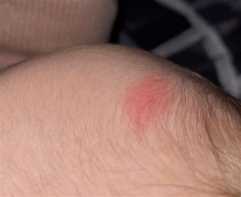 12mo Has Red Patch On Forehead Rdermatologyquestions