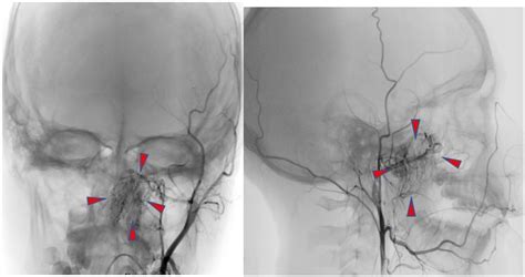 Angiofibroma Juvenil