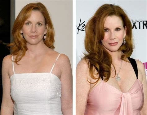 Melissa Gilbert Removes Her Breast Implants