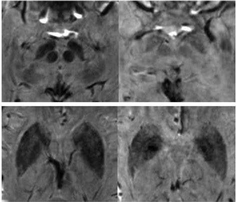Susceptibility Weighted Imaging Magnitude Diagram Upper Images Show