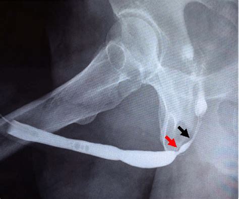 Membranous Urethral Black Arrow And Bulbar Stricture Black Arrow