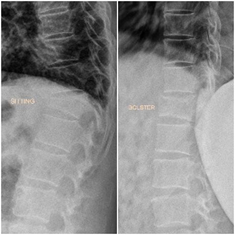 Osteoporotic Fractures Spinedrx