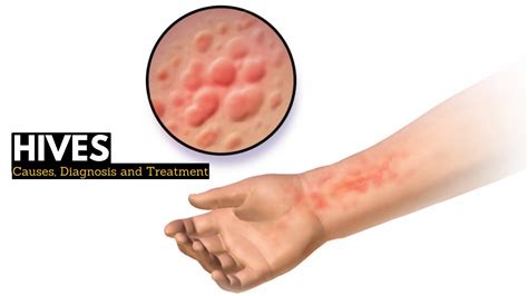 Hives What Causes Those Itchy Bumps