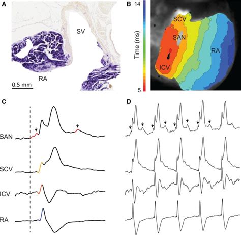 Sinus Venosus Incorporation Contentious Issues And Operational
