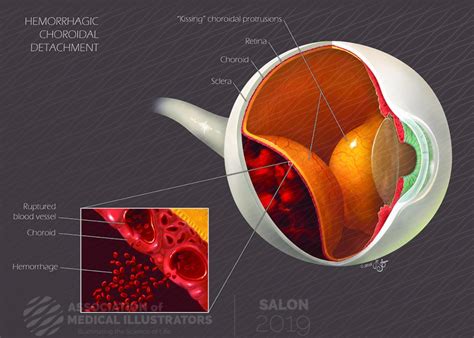 Hemorrhagic Choroidal Detachment Ami 2019