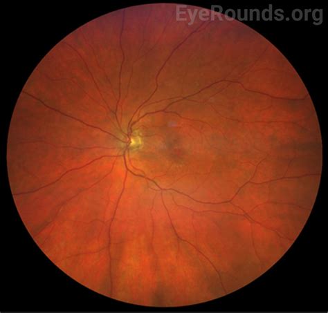 Acute Syphilitic Posterior Placoid Chorioretinitis