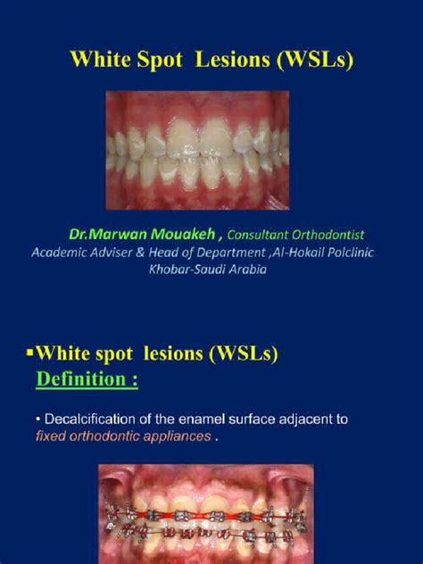 White Spot Lesions Pdf