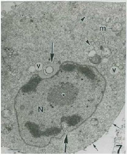 A More Advanced Apoptotic Stage The Nucleus N Presents Condensed