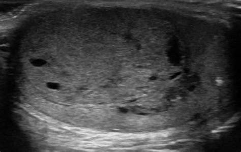 Urinary Tract And Male Reproductive System 23 Scrotum Case 239