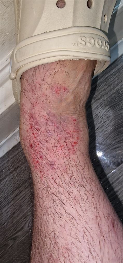 Is This Ring Worm R Diagnoseme