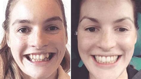 People With And Without Braces