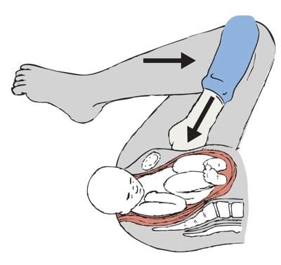Mcroberts Maneuver
