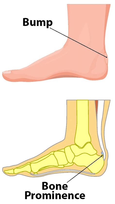 Battling Haglunds Deformity A Journey Toward Relief Foot Ankle And Body Experts Health Clinic