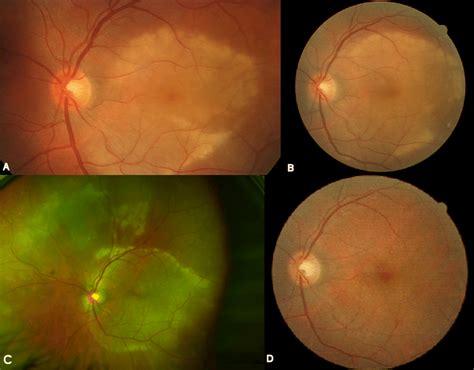 A Colour Photograph Of The Left Eye Shows A Large Yellow Macular