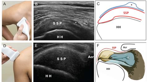 Shoulder Normal And Pathology Internet Book Of Msk Ultrasound