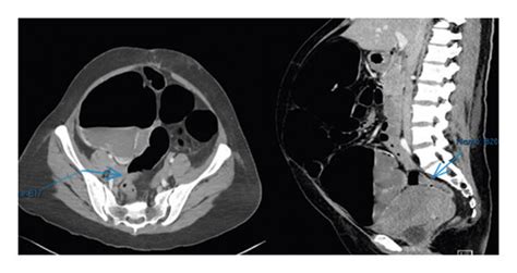Whole Abdominal Ct Scan With Contrast Description Large Bowel