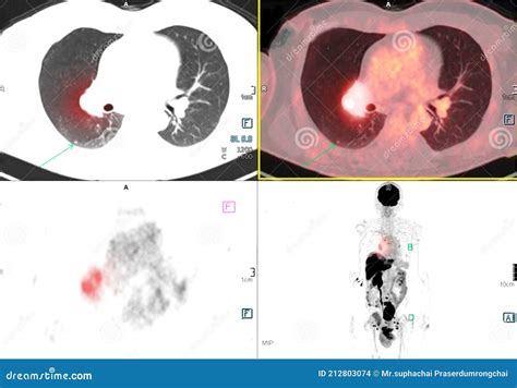 Lung And Thorax Stock Illustration 30724498