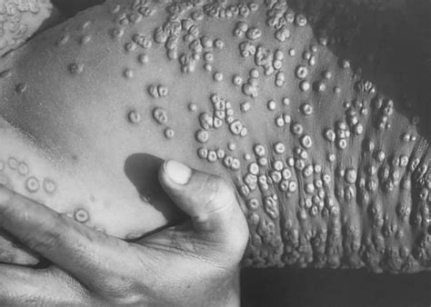 Small Pox 🤢 Scrolller