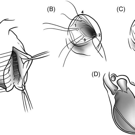 Linear Excision Of An Anterolateral Aneurysm A The Aneurysm Is