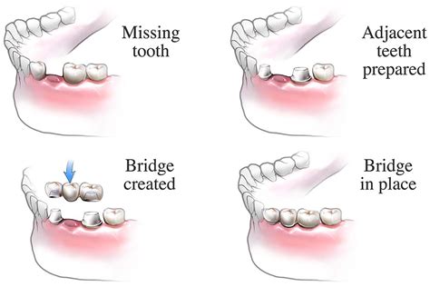 What Is Dental Bridging At Marco Linder Blog