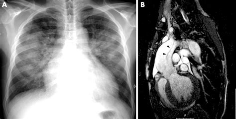 International University Aortic Disruption