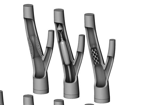 Carotid Artery Stenting Procedure Diorama 3d Model By Rachidsw