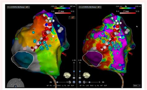 Istmo Dependent Atrial Flutter Ablation With Electroanatomic System