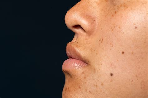 What Causes Dark Spots On Your Face Common Causes Explained