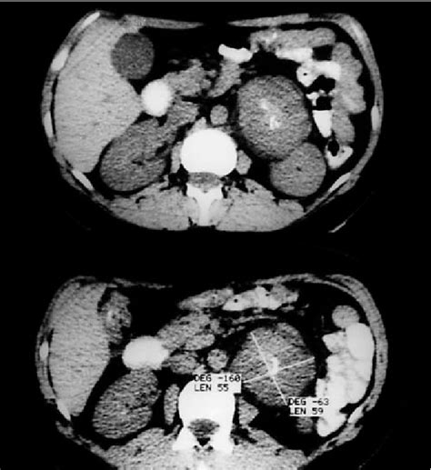 Figure 1 From A Rare Retroperitoneal Benign Tumor Semantic Scholar