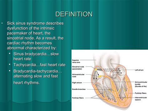 Sick Sinus Syndrome 2 Ppt