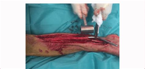 Anteromedial Approach With A Distal Tibial Corticotomy Flap Download Scientific Diagram