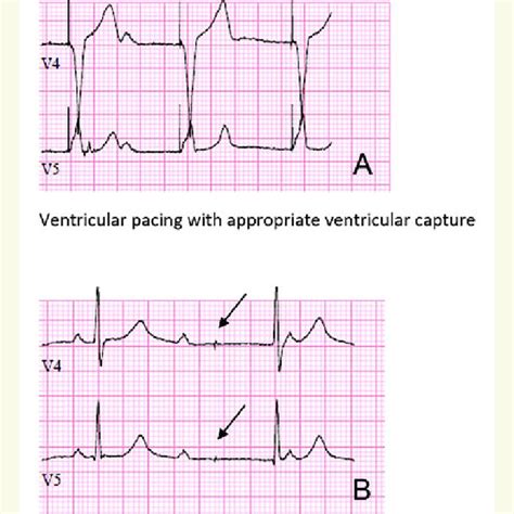 Pdf Case Series Of Late Lead Dislodgement Of Medtronic Selectsecure 3830 Pacing Leads In