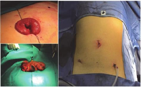 Technical Aspects Of Small Bowel Laparoscopic Resection Because Of The