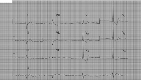 Ecg Case 147 Digoxin Effect With Possible Digoxin Toxicity Manual Of