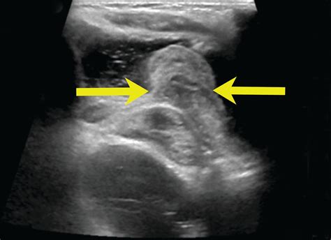 Ileo Colic Intussusception Applied Radiology