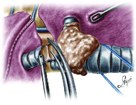 Division Of The Bronchus Intermedius Download Scientific Diagram