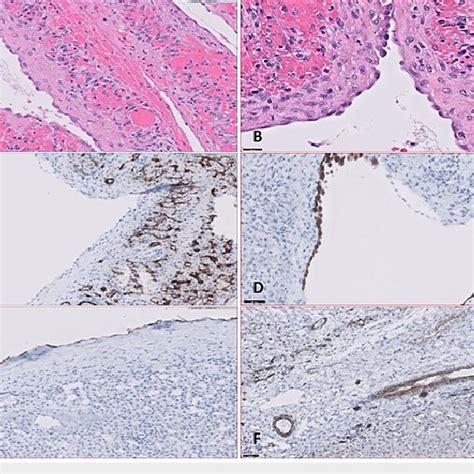 Representative Histology From Case 1 And Case 2 Representative Sections